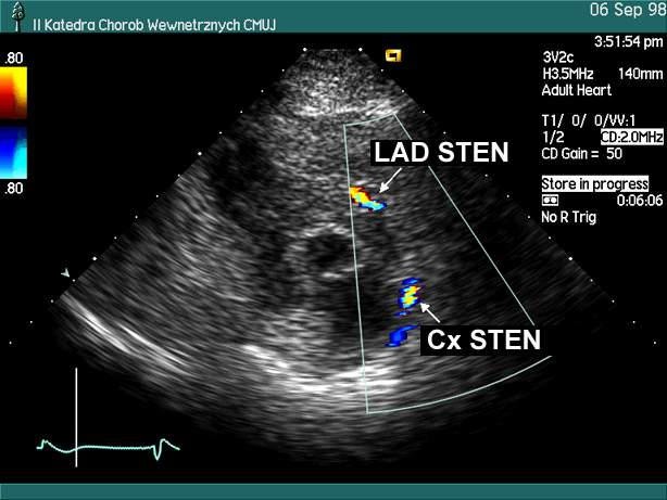 Imaging of all three coronary arteries by transthoracic ...