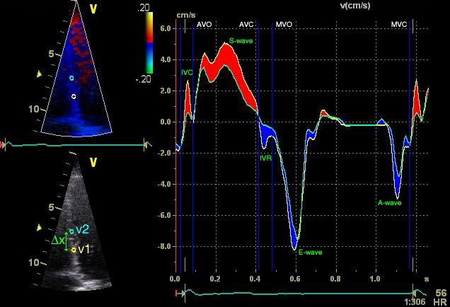 Echocardiographic quantification of myocardial function using tissue ...