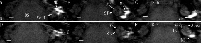 Manufacturing and in vivo inner ear visualization of MRI traceable ...