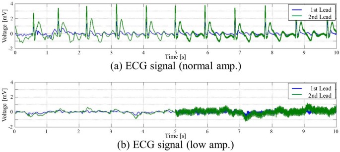 Morphology-matching-based R-wave detection for noise-robust ECG gating ...