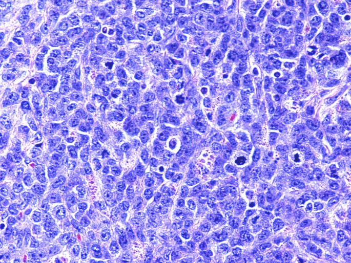 Myeloid sarcomas: a histologic, immunohistochemical, and cytogenetic ...