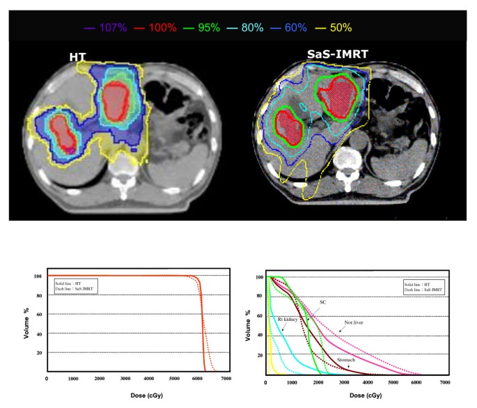 Helical tomotherapy for single and multiple liver tumours | Radiation ...
