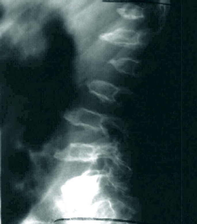 Mucopolysaccharidosis VI | SpringerLink