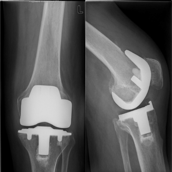 An impinging remnant meniscus causing early polyethylene failure in ...