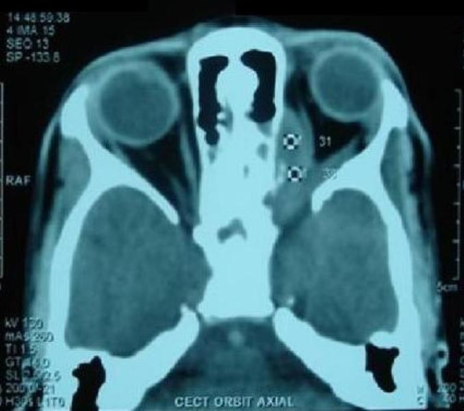 Orbital tuberculosis in childhood with intracranial extension: a case ...