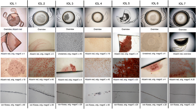 Hydrophilic intraocular lens opacification after posterior lamellar ...