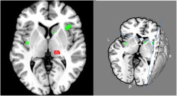 Cerebral metabolism in major depressive disorder: a voxel-based meta ...