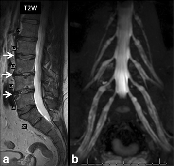 Magnetic resonance imaging of bacterial and tuberculous spondylodiscitis with associated ...