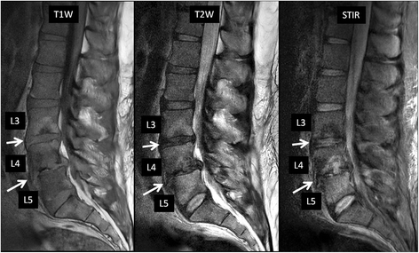 Magnetic resonance imaging of bacterial and tuberculous ...