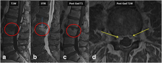 Magnetic resonance imaging of bacterial and tuberculous ...