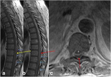 Magnetic resonance imaging of bacterial and tuberculous ...