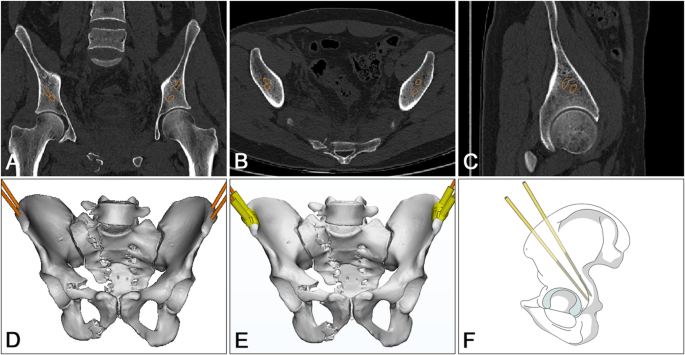 A feasibility study of individual 3D-printed navigation template for ...