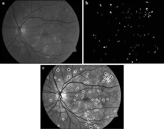 Automatic non-proliferative diabetic retinopathy screening system based on color fundus image ...