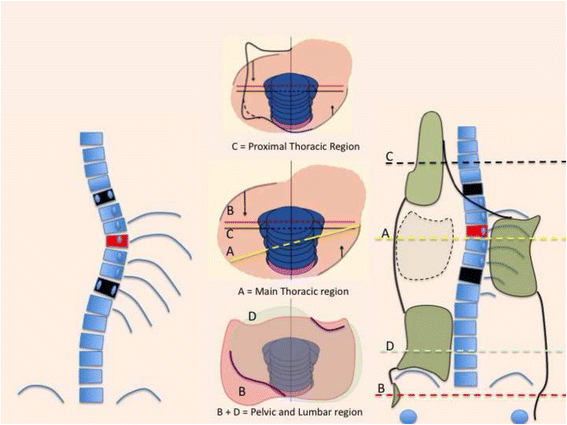 Brace technology thematic series: the 3D Rigo Chêneau-type brace ...