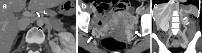 CT imaging findings of abdominopelvic vascular compression syndromes: what the radiologist needs ...