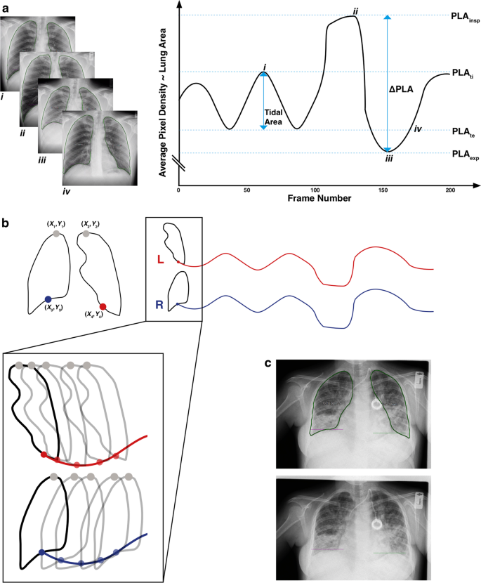 Dynamic chest radiography: a state-of-the-art review | Insights into ...