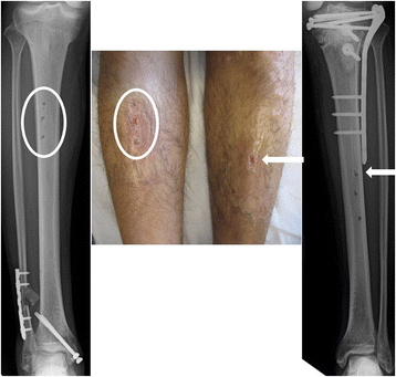 Delayed methicillin-resistant Staphylococcus aureus-induced ...