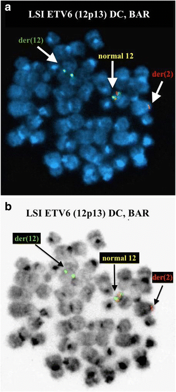 A case of B-cell acute lymphoblastic leukemia in a child with Down ...