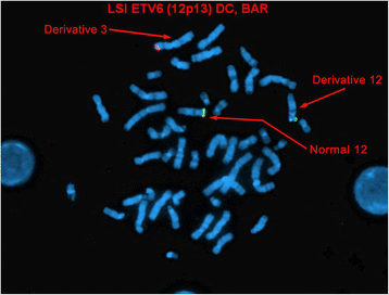 A novel three-way rearrangement involving ETV6 (12p13) and ABL1 (9q34 ...