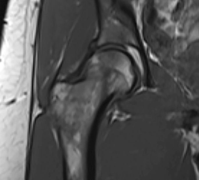 MRI and MR Arthrography | SpringerLink