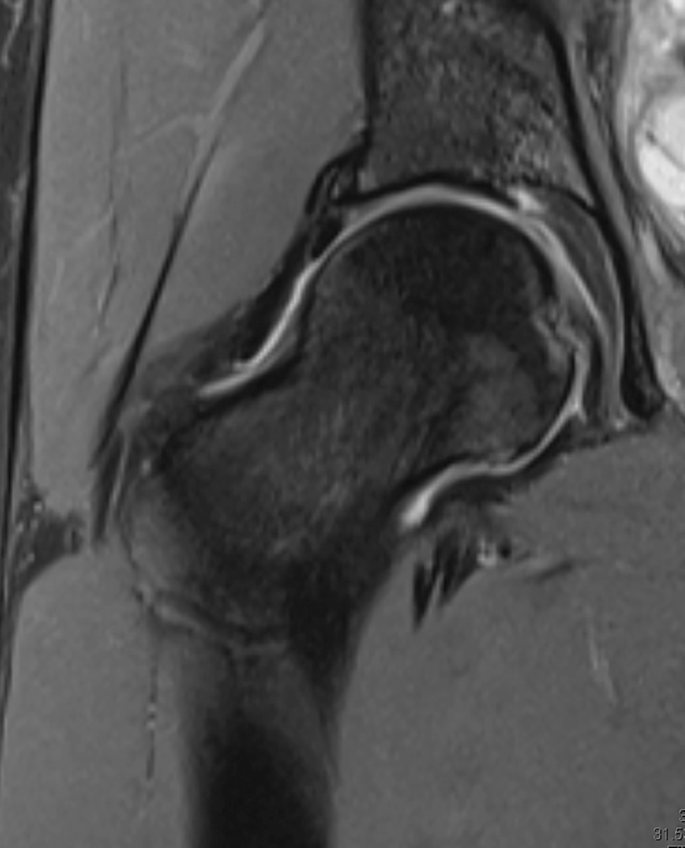 MRI and MR Arthrography | SpringerLink