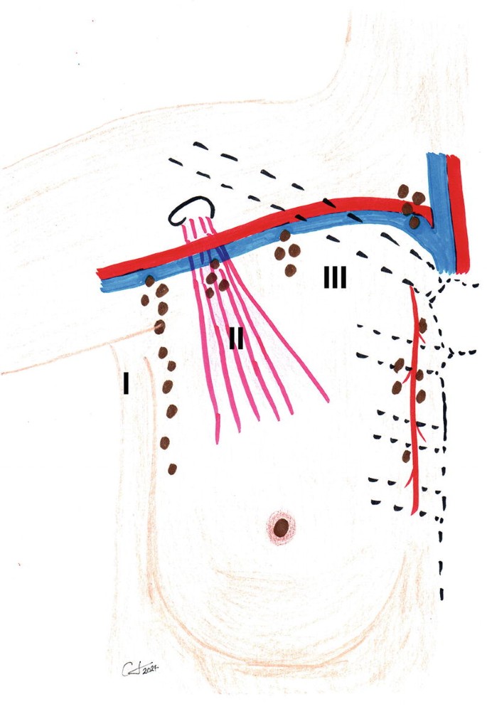 Axillary Lymph Node Imaging in Breast Cancer | SpringerLink