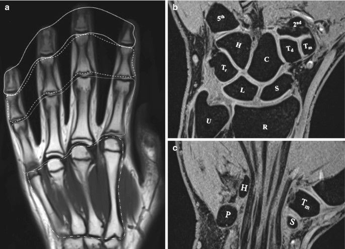 MR Imaging of the Hand and Wrist: Techniques and Applications ...