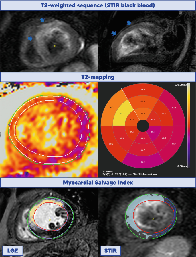 Imaging of Atherosclerotic Heart Disease | SpringerLink