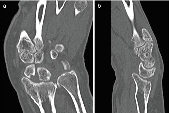 Computed Tomography of Hand and Wrist | SpringerLink