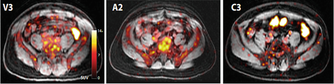 Recent Advancements in Radiopharmaceuticals for Infection Imaging ...