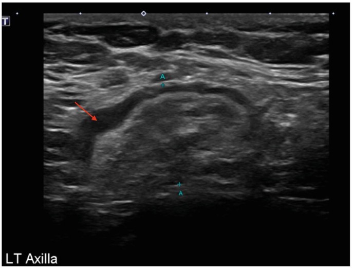 Ultrasound-Guided Fine Needle Biopsy of Human Axillary Lymph Nodes to ...