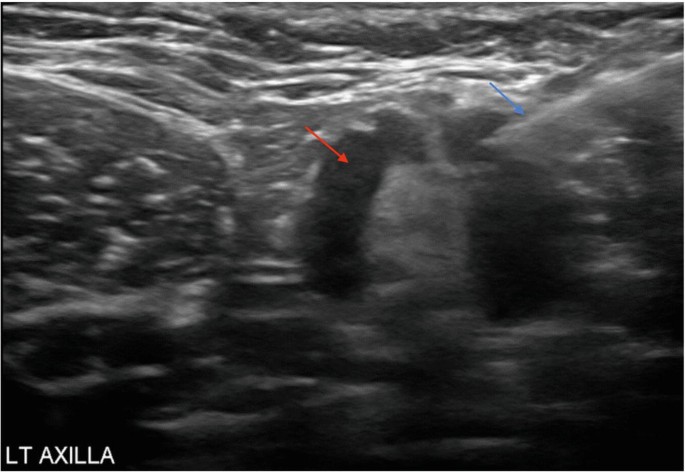 Ultrasound-Guided Fine Needle Biopsy of Human Axillary Lymph Nodes to ...