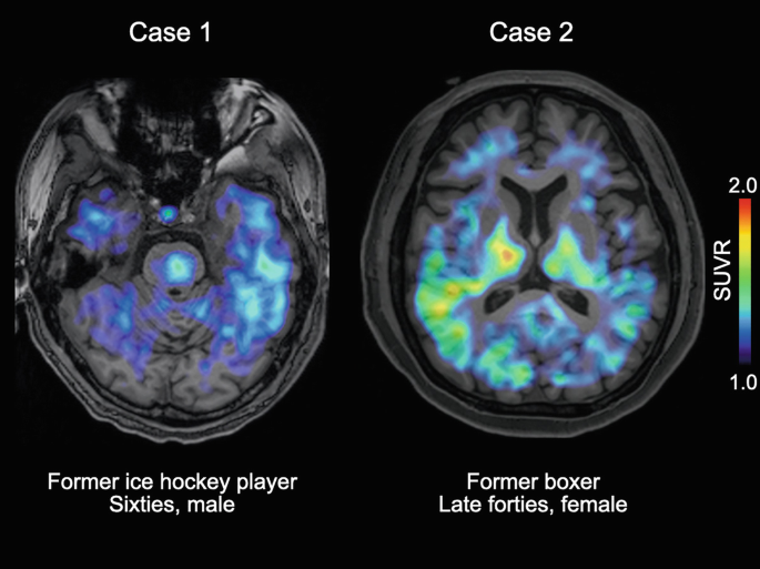 PET Visualization of Brain Tau Accumulations Secondary to Various CNS ...