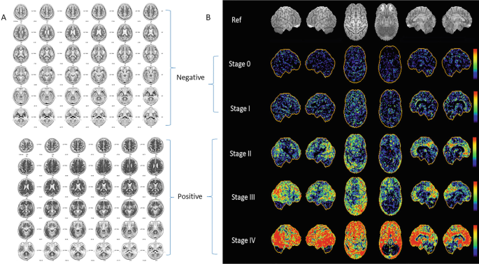 18F-FDG PET for Neurodegenerative Diseases: Principles and Progress ...