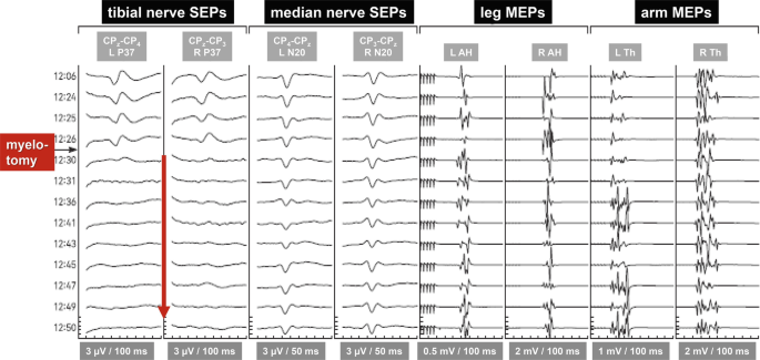 Ketamine as an Adjuvant in Anesthesia for Neurosurgery with ...