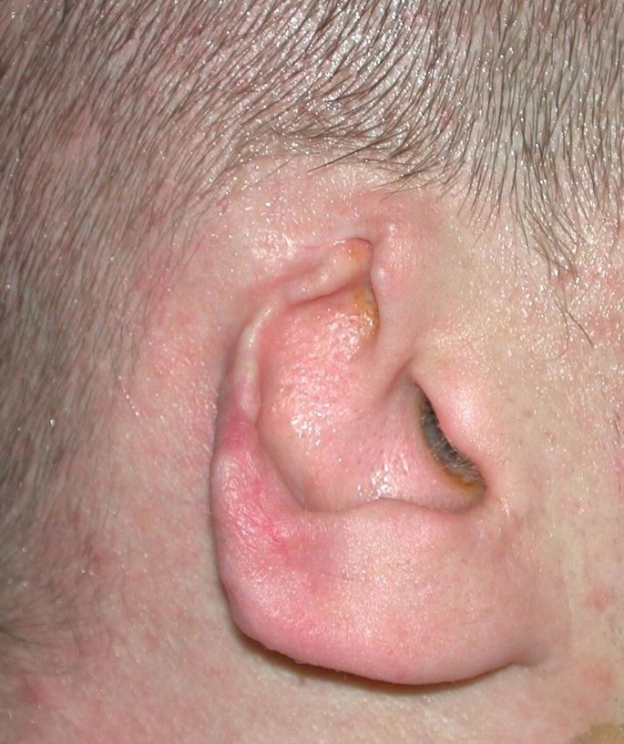 Surgical Reconstruction of the Ear (Pinna) | SpringerLink