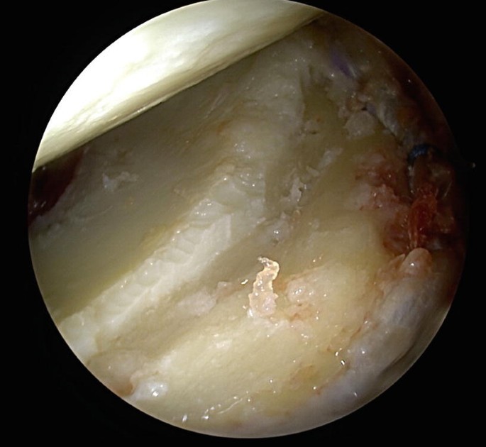 Surgical Technique: Microfracture Adjuvants in Hip Cartilage ...