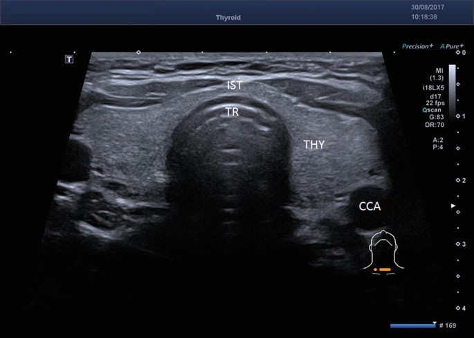 Ultrasound Anatomy of the Head and the Neck | SpringerLink