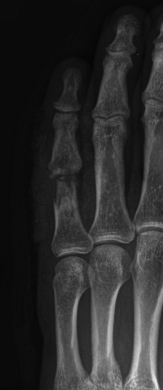 Free PIP Joint Transfer for Functional Finger Reconstruction | SpringerLink