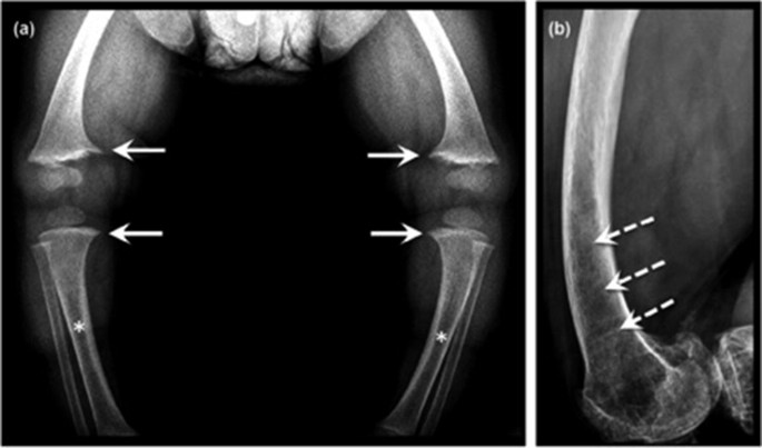 Rickets and Osteomalacia: Vitamin D-Sensitive and -Resistant States ...