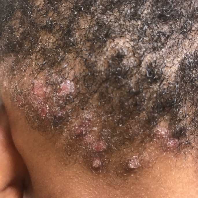 Cutaneous Infections in Black Skin | Springer Nature Link