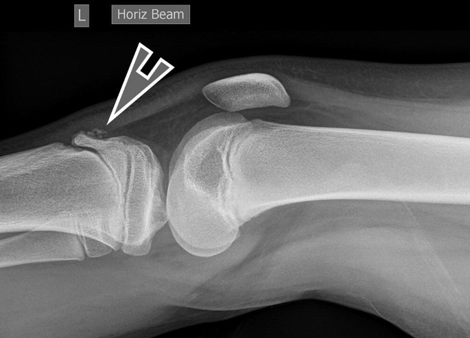 Derangement of the Deep Knee Structures | SpringerLink