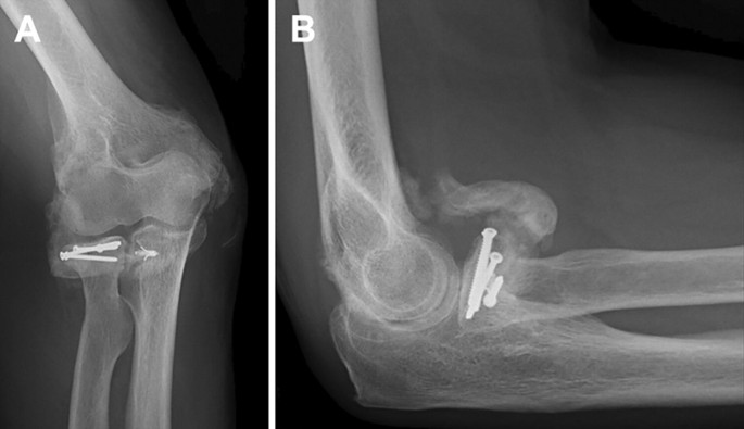 Heterotopic Ossification of the Elbow: Imaging Findings | SpringerLink