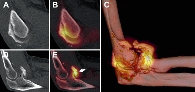 Heterotopic Ossification of the Elbow: Imaging Findings | SpringerLink