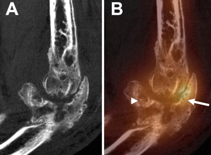 Elbow: Septic Arthritis | SpringerLink