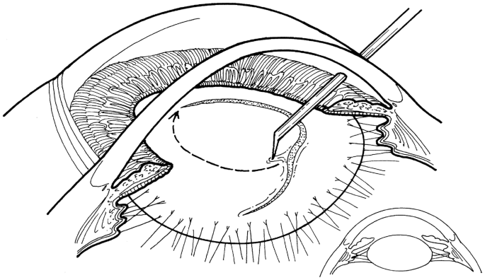 Complications of IOL Surgery | Springer Nature Link