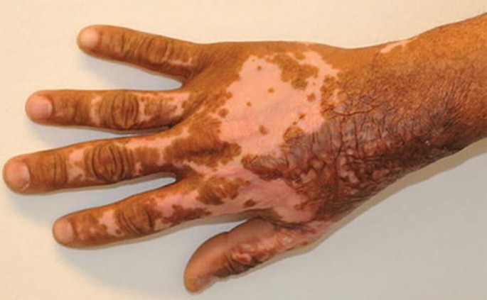 Scar Symptoms: Pigmentation Disorders | SpringerLink