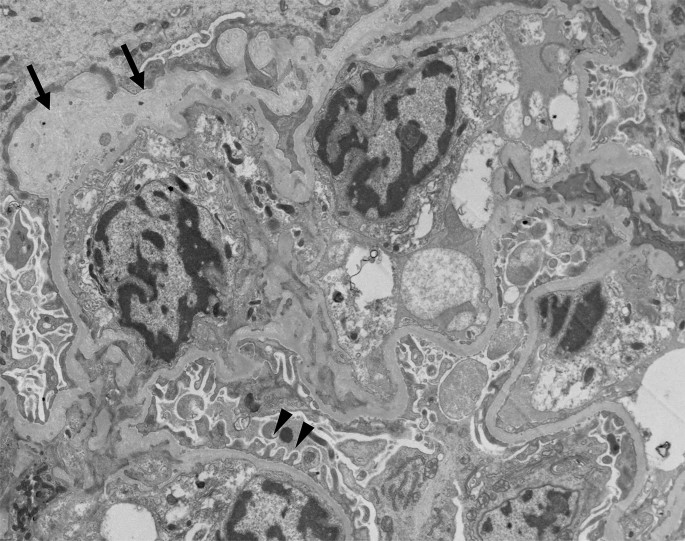 Electron Microscopy of HIV-Related Kidney Disease | SpringerLink