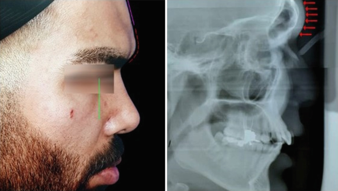 Frontal Bossing Reduction | SpringerLink