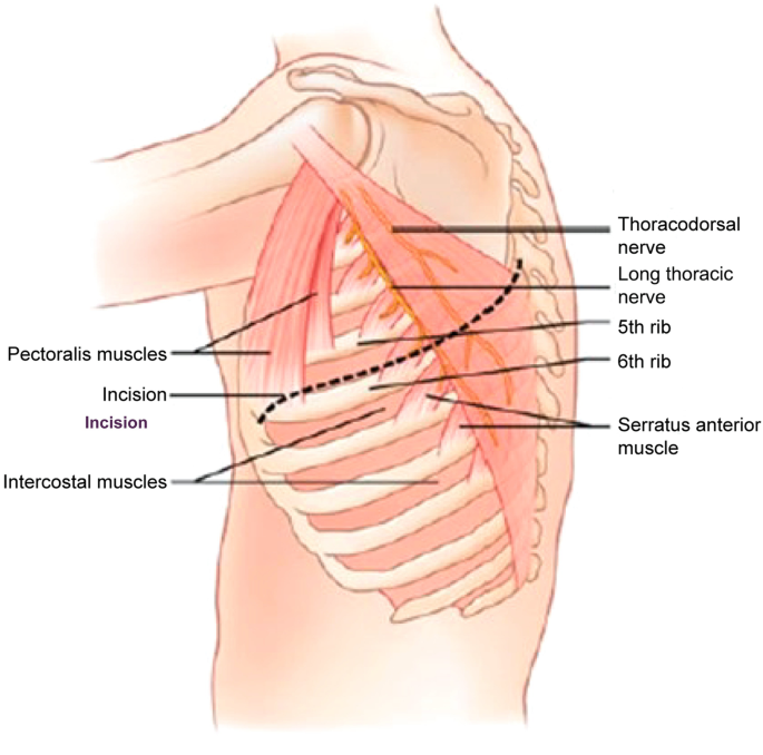 Minimally Invasive Lung Resection: Video-Assisted Thoracic Surgery ...